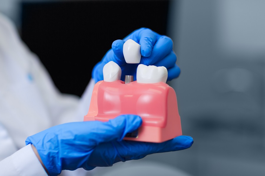 What to Expect After a Root Canal: A Day-by-Day Recovery Guide | Stone ...